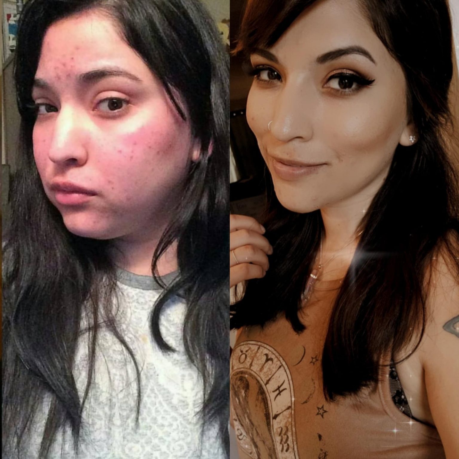 This Is What Trauma Looks Like to Me | Cushing's Disease News